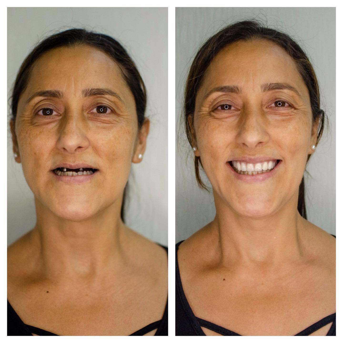 Prótese Dentária - ARC Odontologia