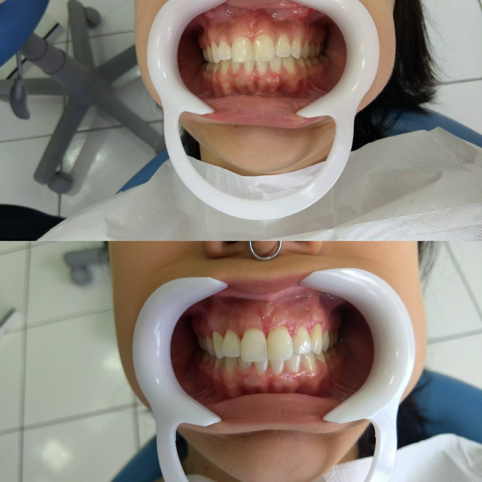 Doenca Periodontal Antes E Depois Das Fotos Periodontologia